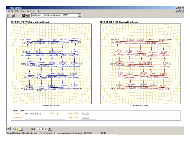 Motility test HESS Screen Pro | For Vision Tests | Software | VISUS ...